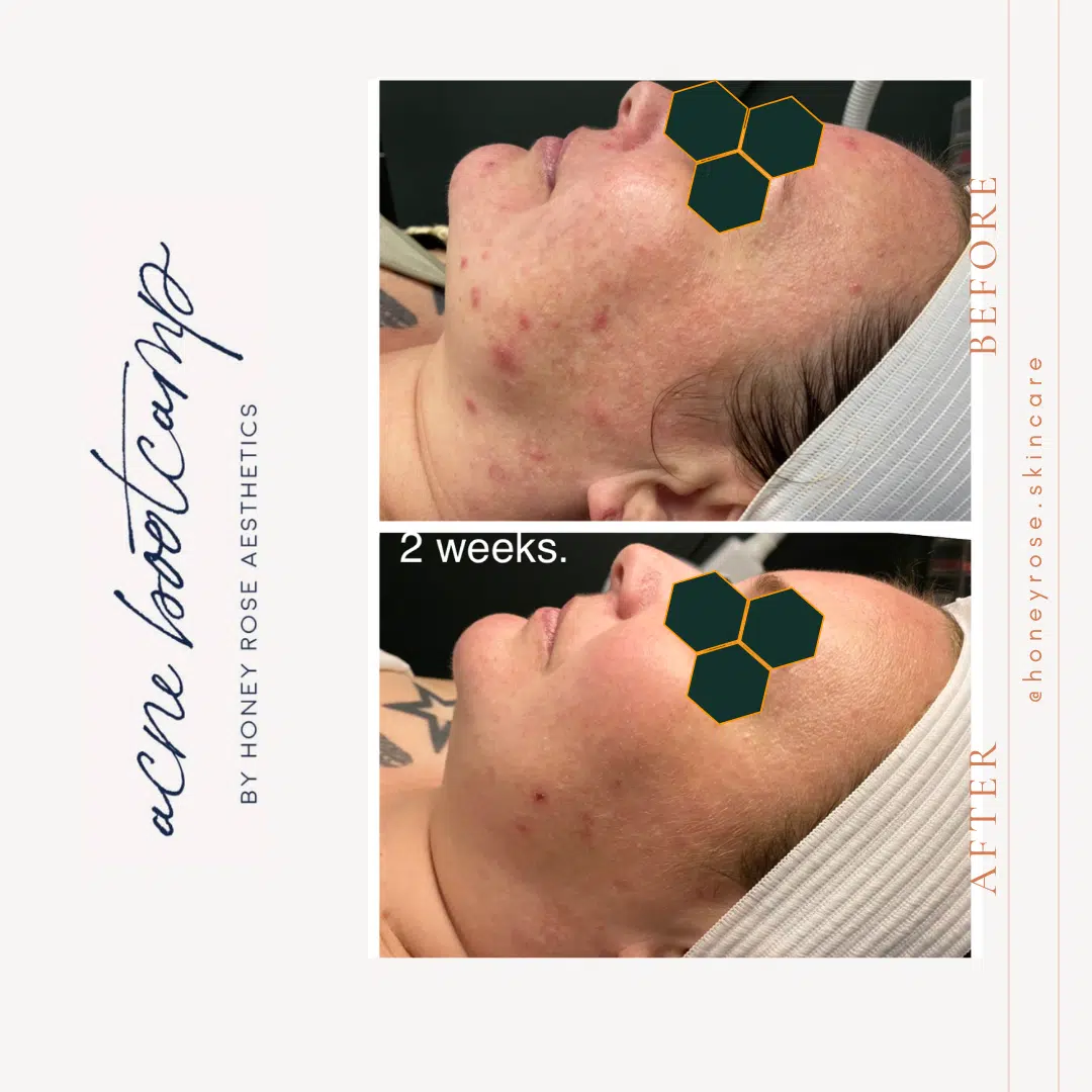 Acne Treatment Program in Puyallup, WA | HRA Skin